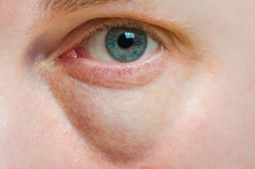 Puffy swollen eye - Marcelo Creppe I Oftalmologista
